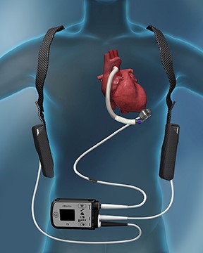 INTEGRIS Health Implants 100th HeartMate 3 LVAD | INTEGRIS Health